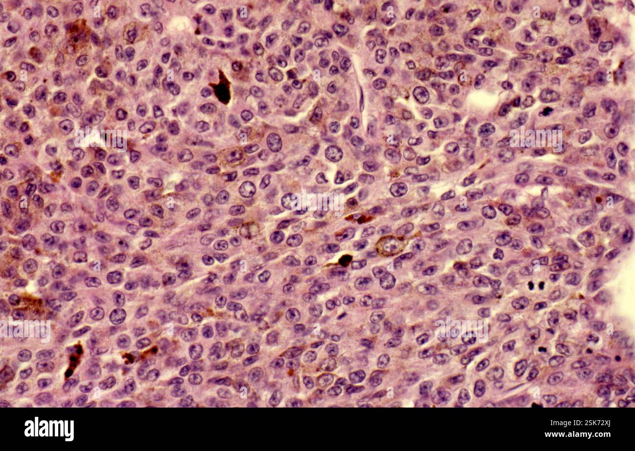 Light micrograph of a malignant melanoma of the choroid, the vascular ...