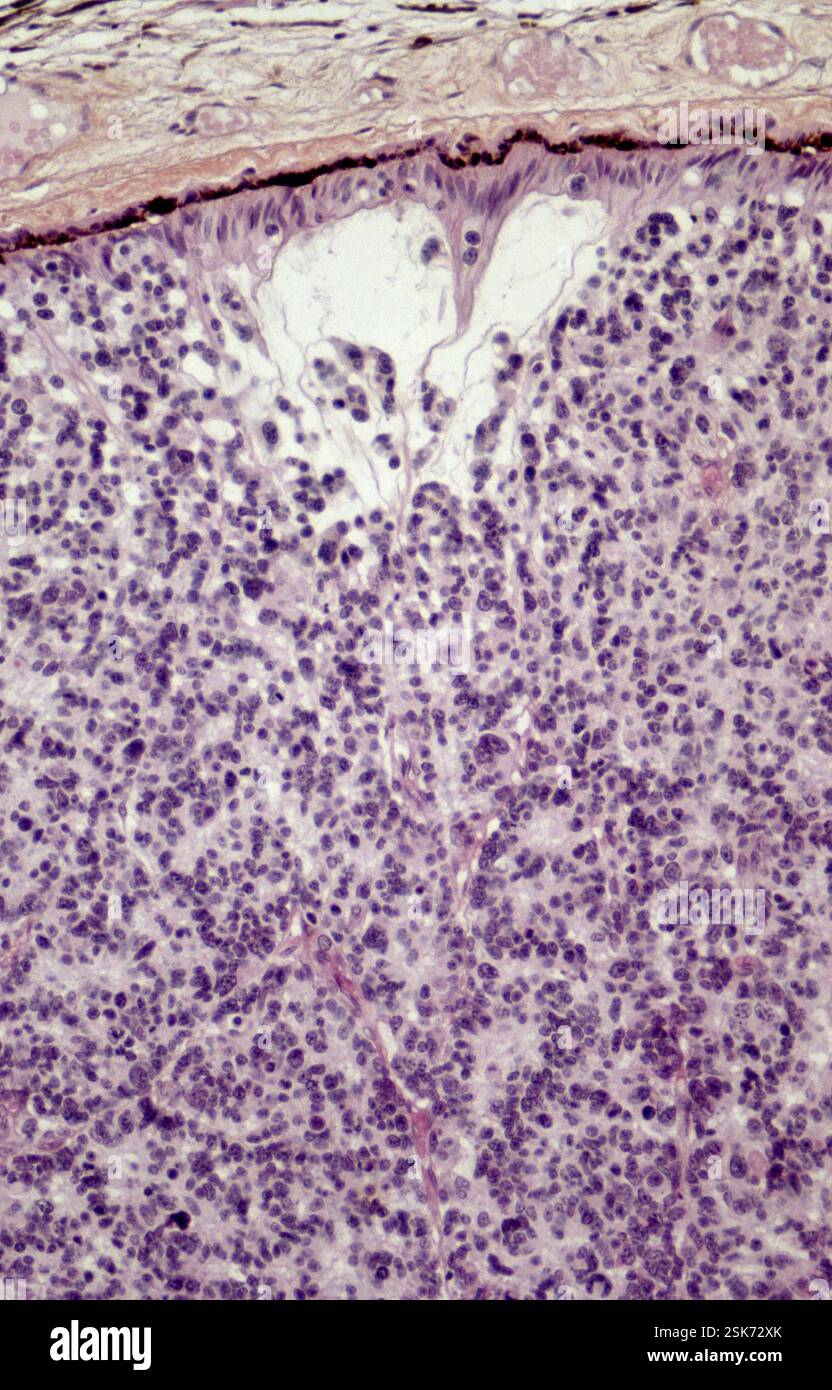 Light micrograph of a section of the retina (bottom) and choroid ...