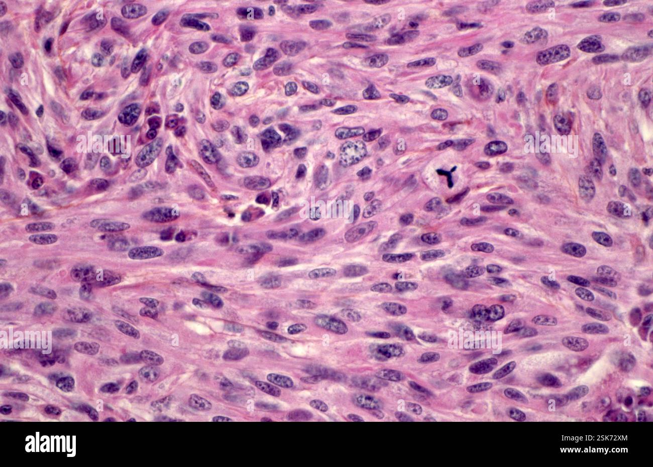 Light micrograph of a malignant melanoma of the choroid, the vascular ...