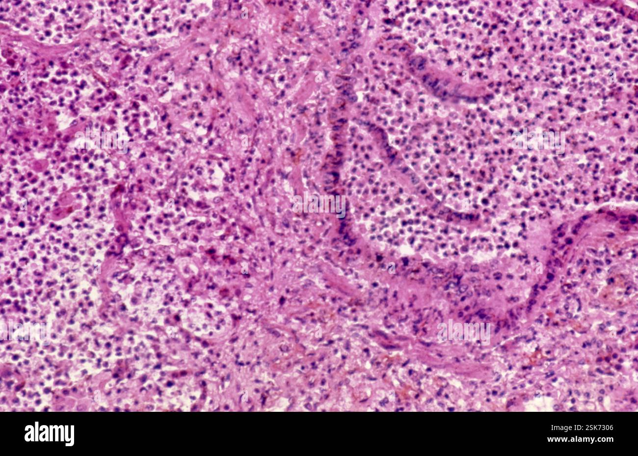 Light micrograph of human lung tissue affected by acute ...