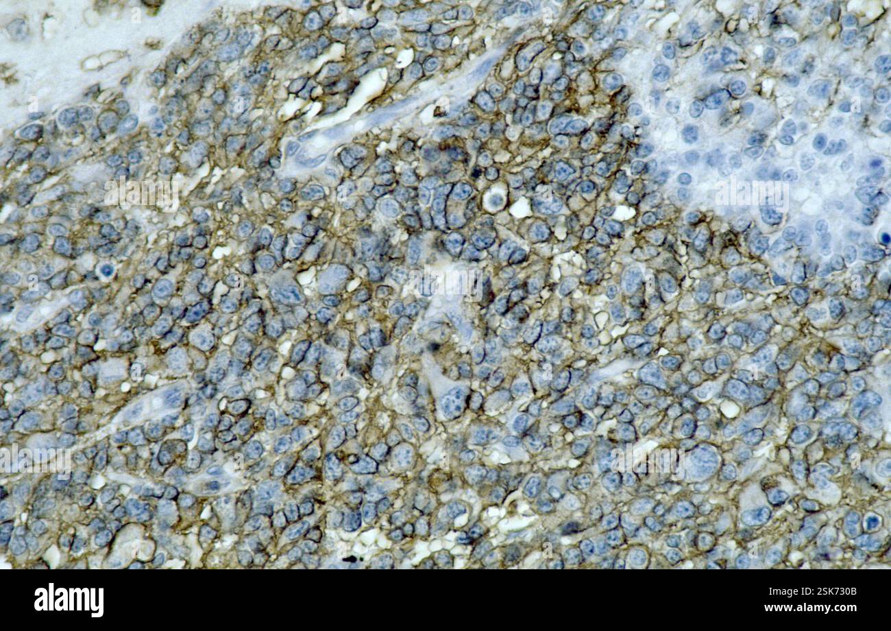 Light micrograph of a section of the retina from a patient with adult ...