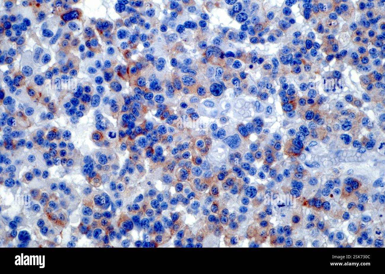 Light micrograph of a section of the retina from a patient with adult ...