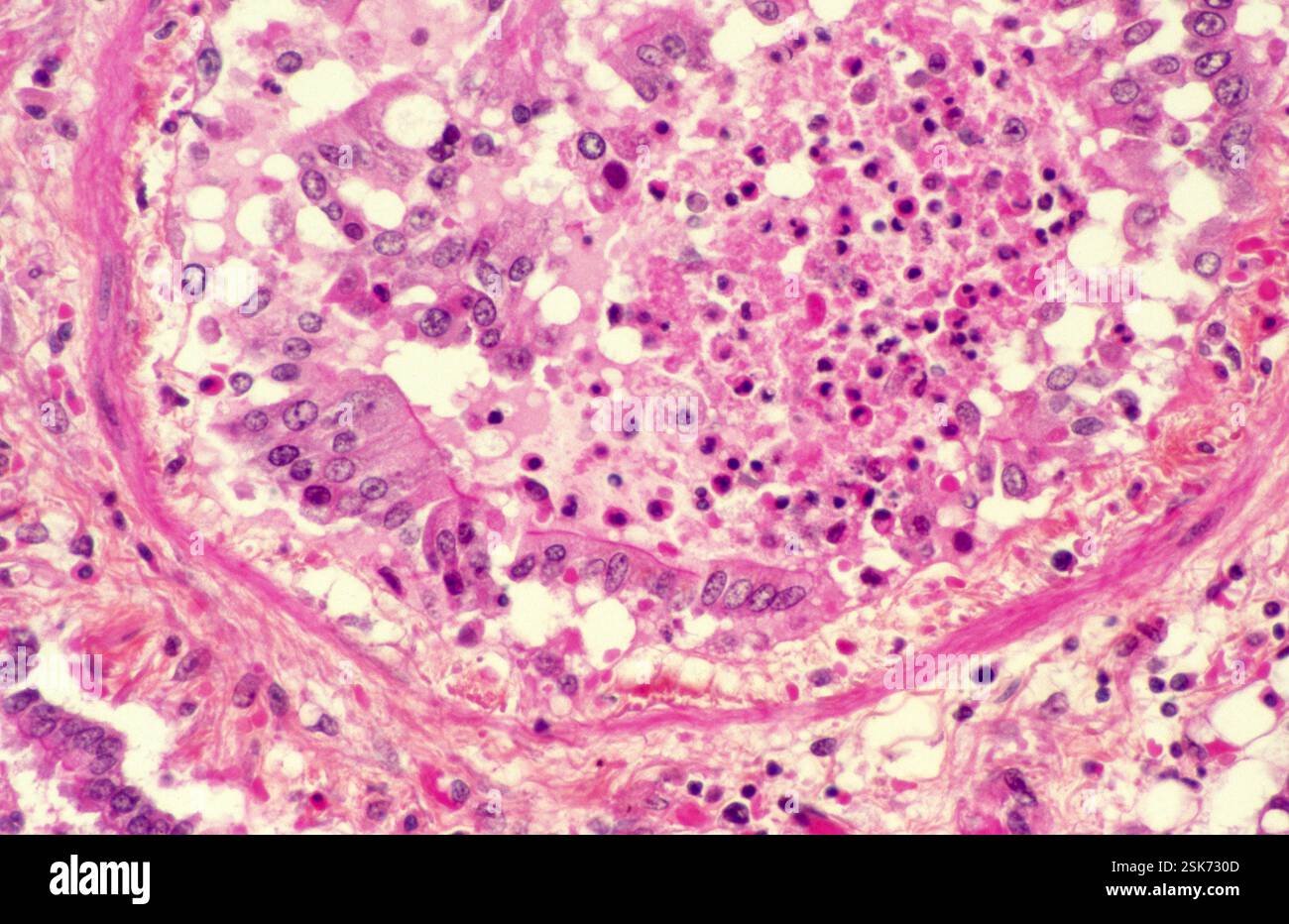 Light micrograph of human lung tissue affected by acute ...