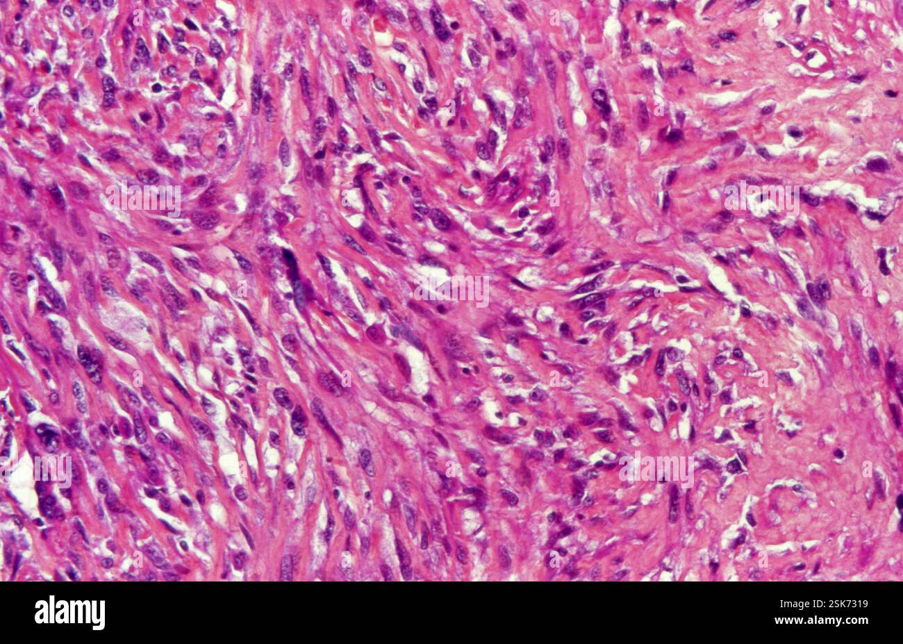 Cancer of the larynx, CT scan Stock Photo - Alamy