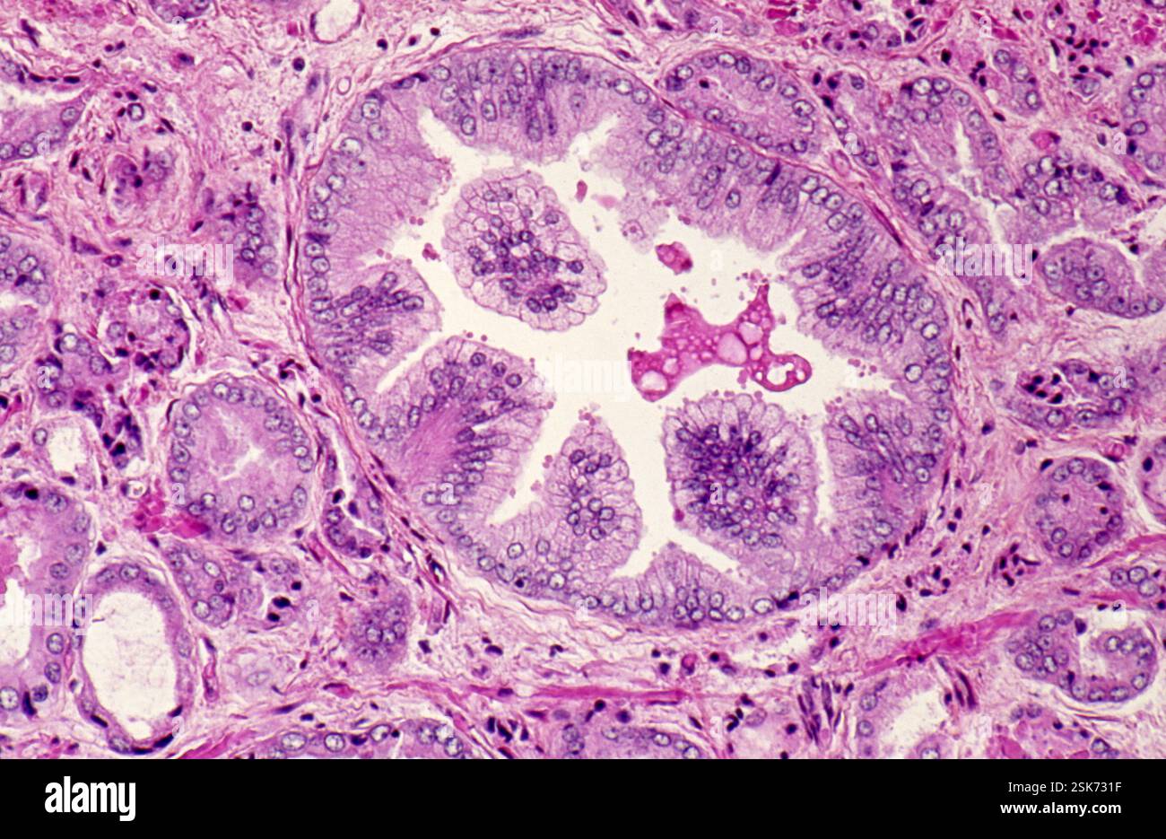Light micrograph of a prostate adenoma, showing low-grade ...