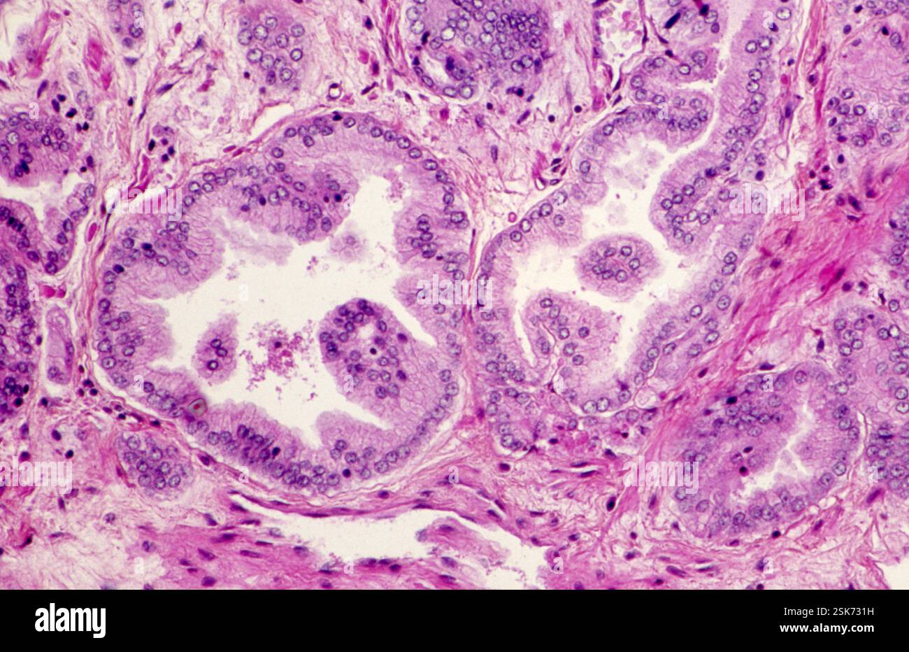 Light micrograph of a prostate adenoma, showing low-grade ...