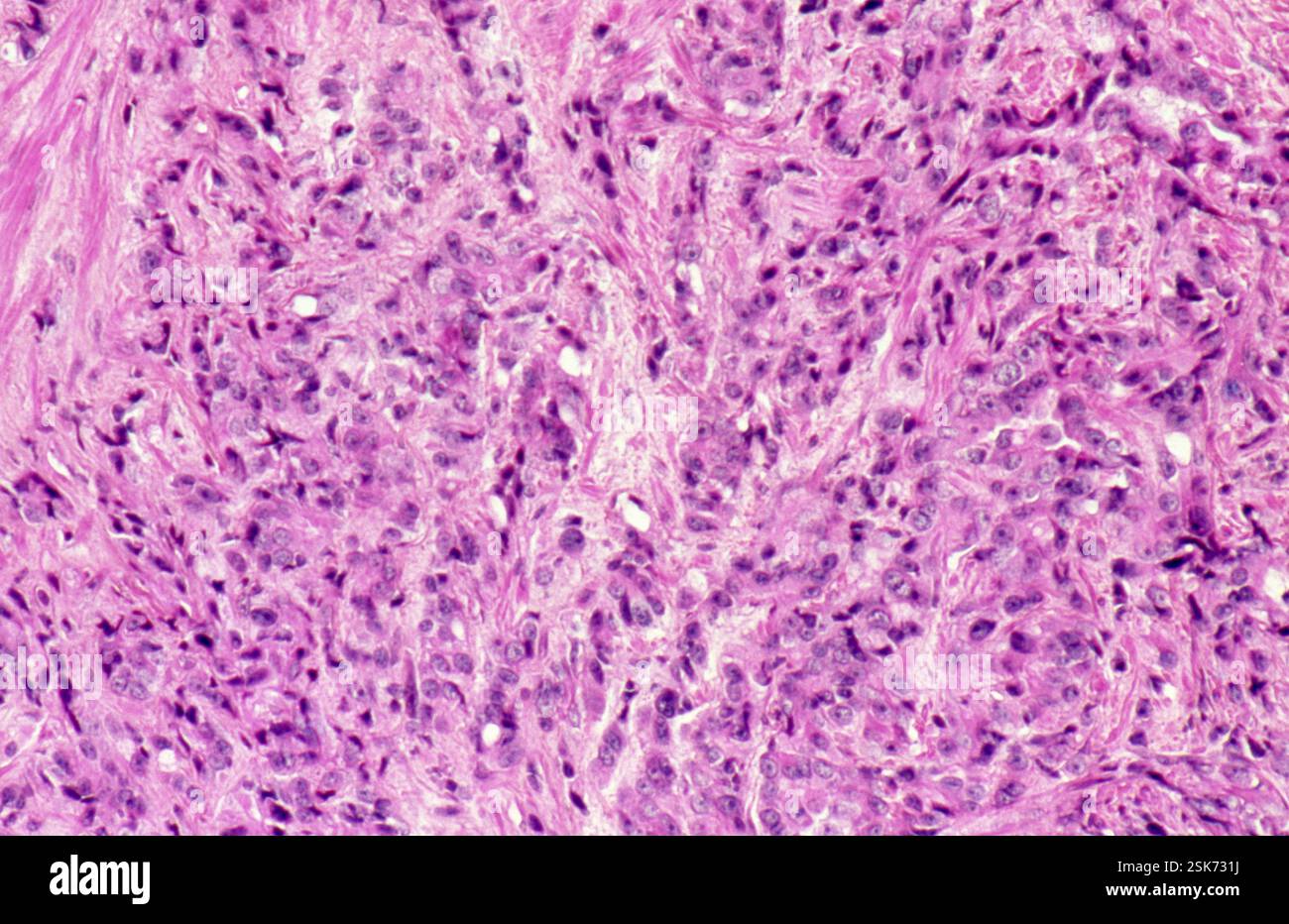 Light micrograph of an adenocarcinoma of the prostate, shown by ...