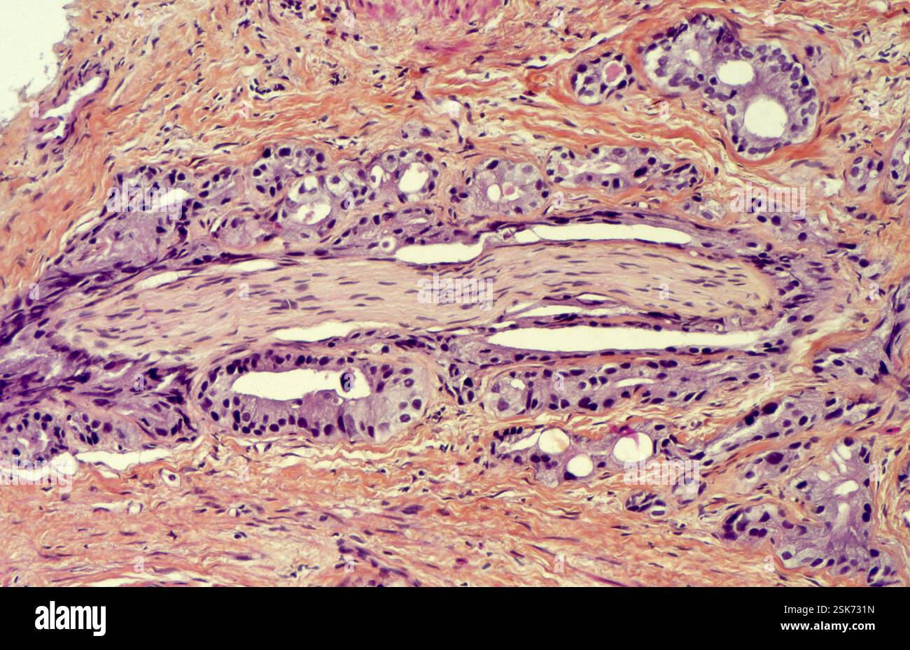 Light micrograph of an adenocarcinoma of the prostate, shown by ...