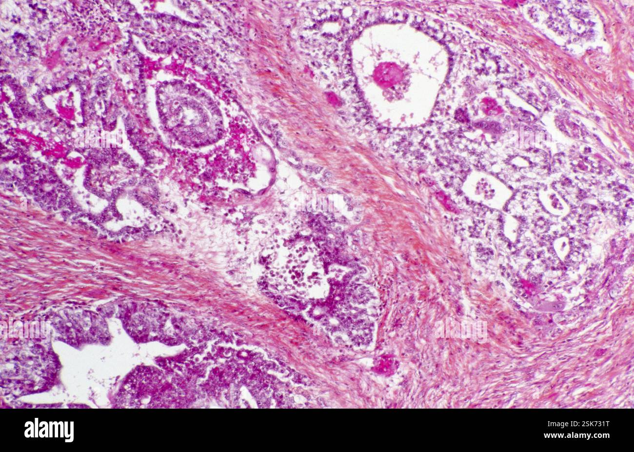 Light micrograph of an embryonal carcinoma of the testis. This is a ...