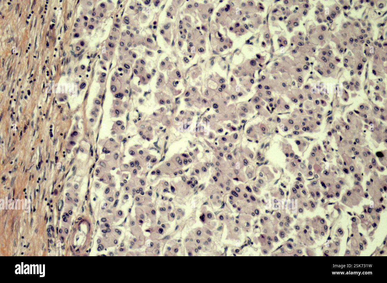 Light micrograph of a section through a kidney affected by chromophobe ...