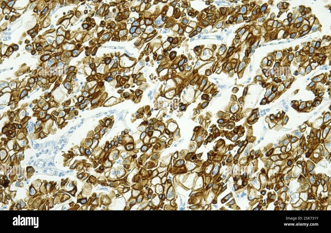 Light micrograph of a section through a kidney affected by chromophobe ...