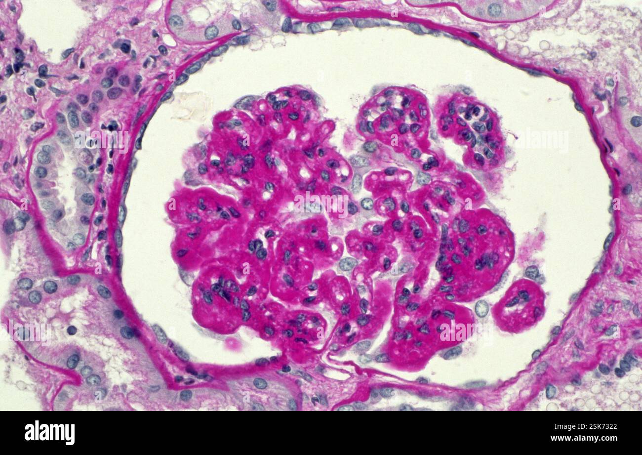 Brain vein inflammation, 3-D CT scan Stock Photo - Alamy