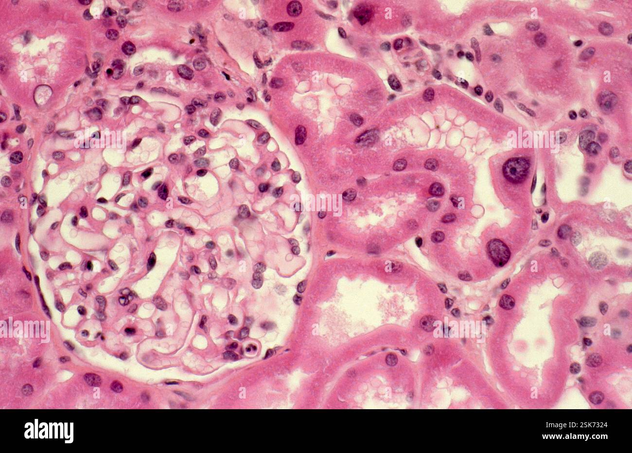 Light micrograph of karyomegaly in tubular kidney cells, visible as ...