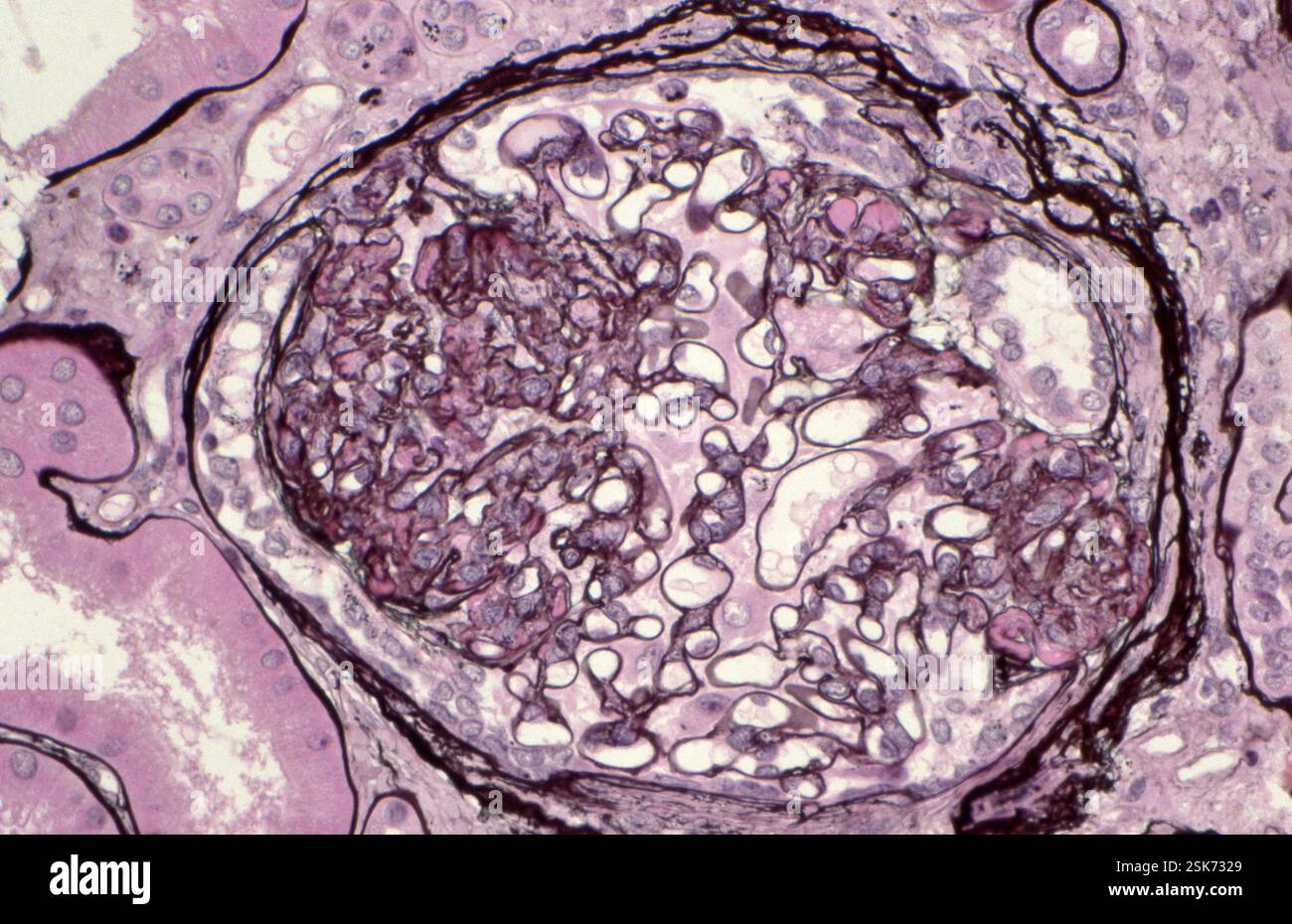 Light micrograph of a section of kidney with glomerular hyalinosis ...