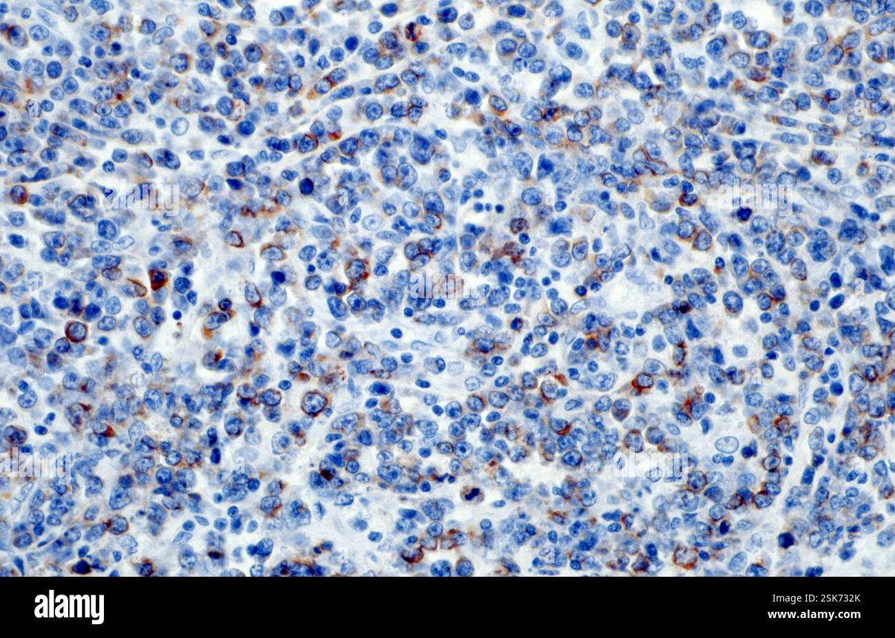 Light micrograph of a section of testicular with a diffuse large B-cell ...