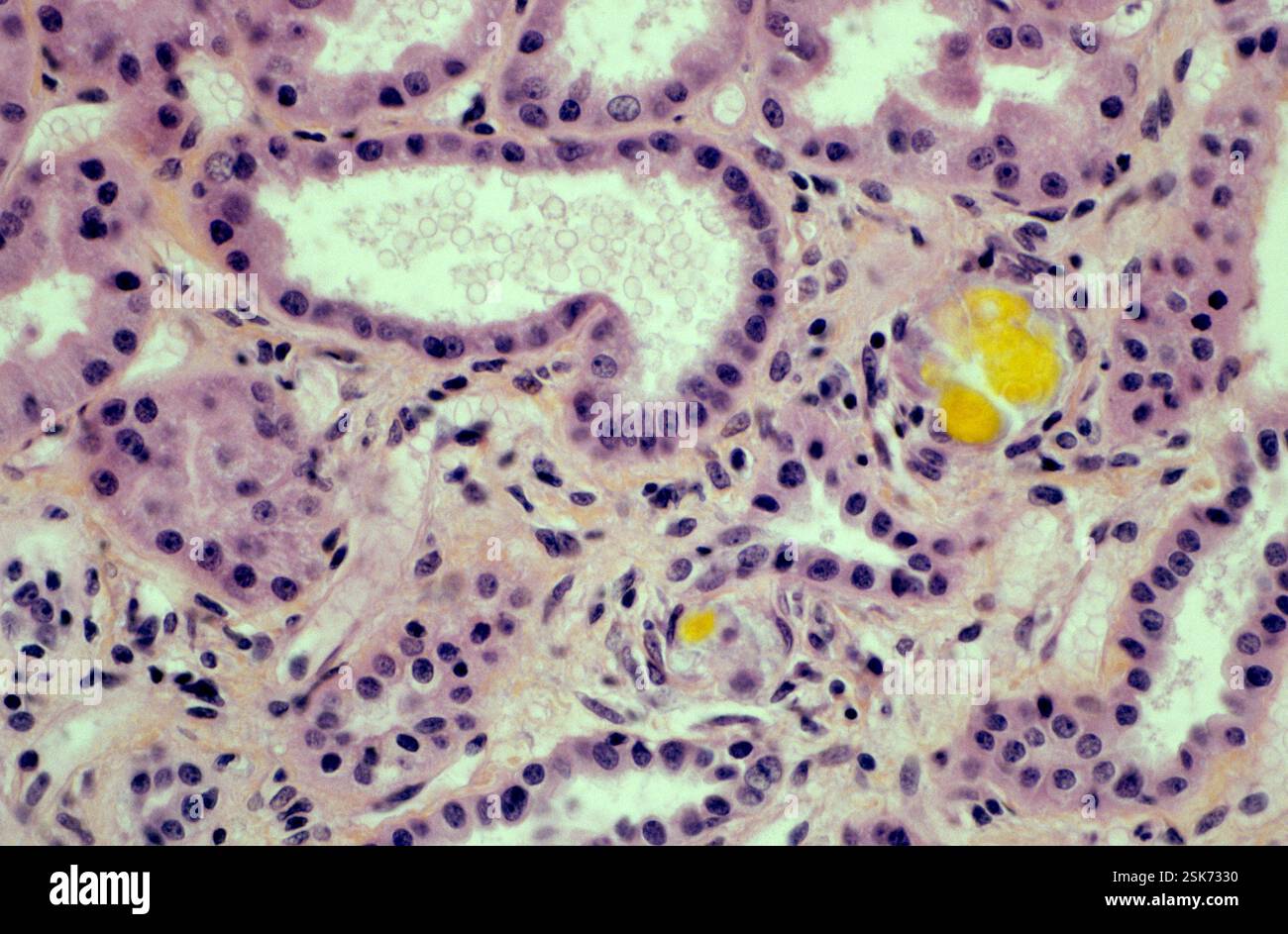 Light micrograph of nephrocalcinosis (yellow), or calcification of the ...