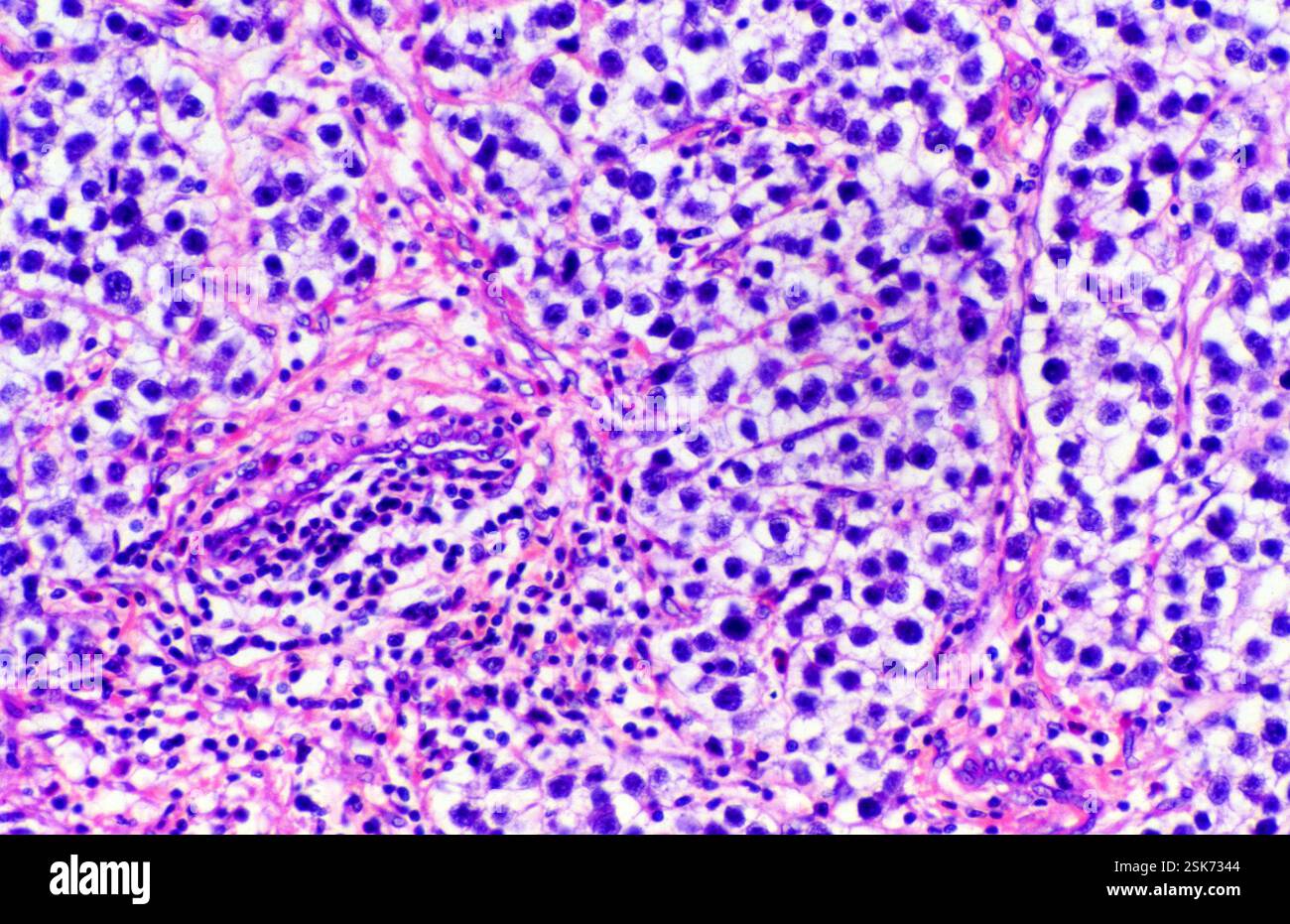 Light micrograph of a seminoma of the testis, a cancer that forms in ...