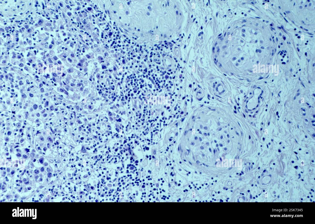 Light micrograph of a seminoma of the testis, a cancer that forms in ...