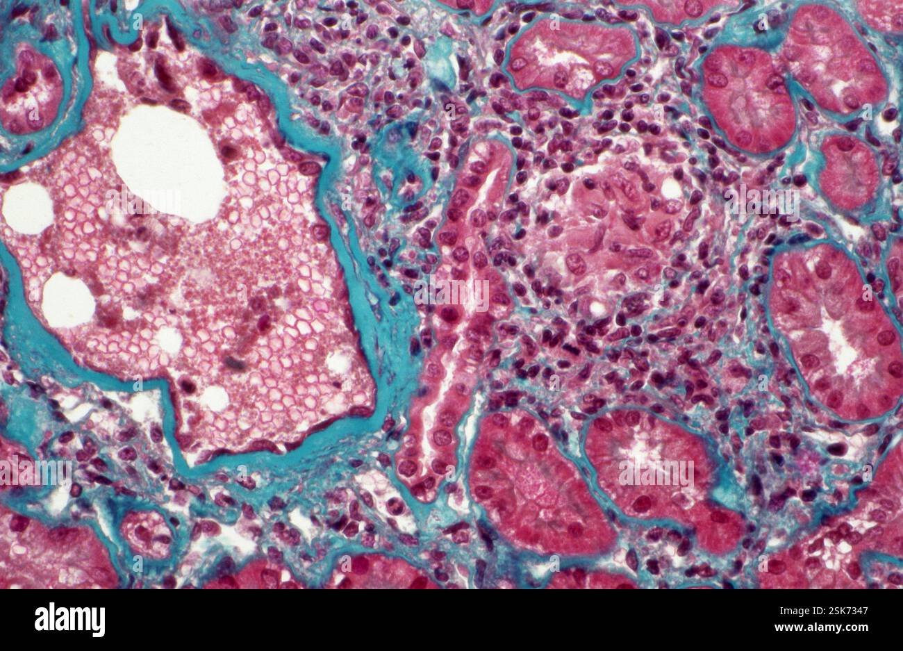 Light micrograph of a section of kidney with renal sarcoidosis, shown ...