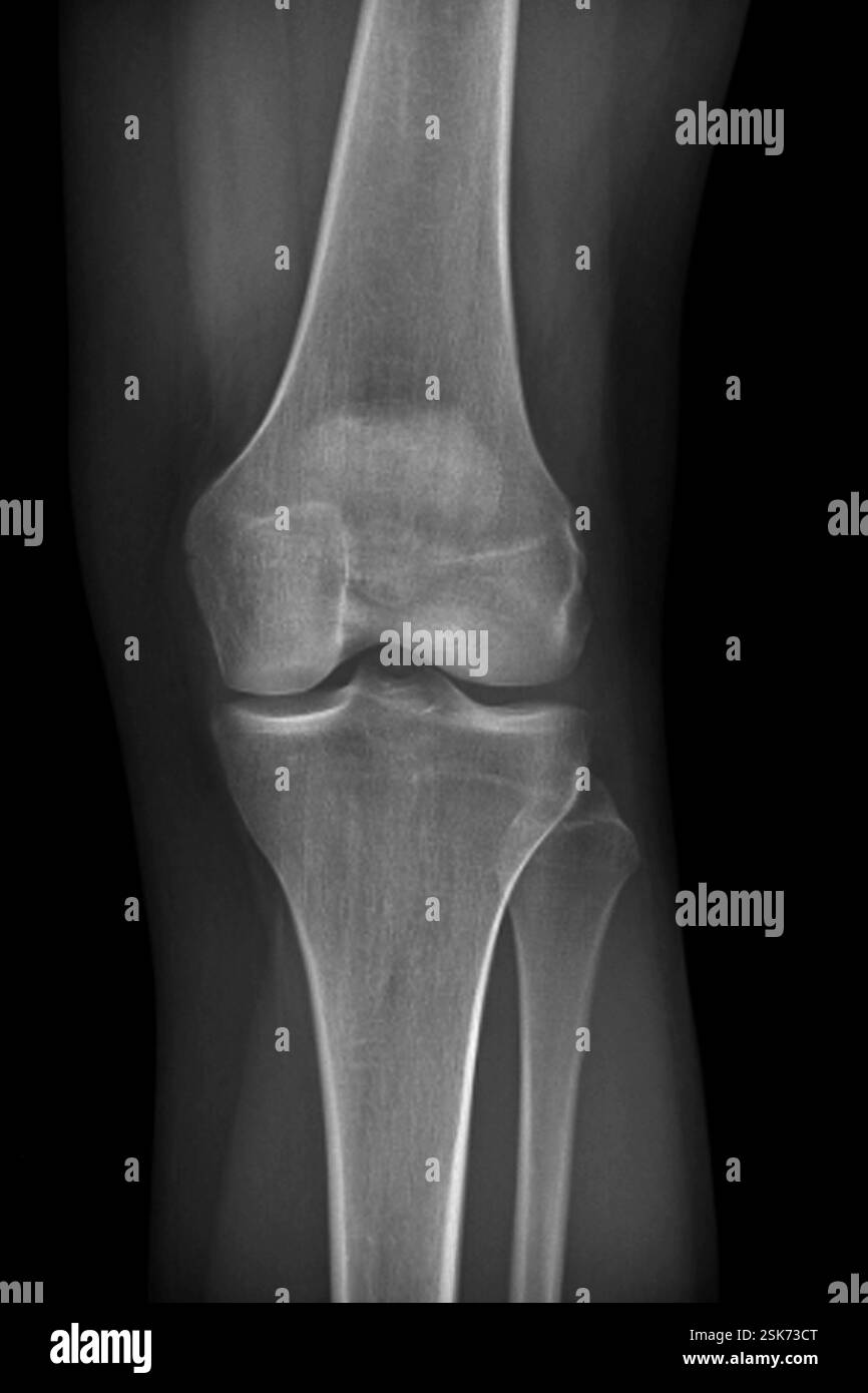 Normal knee. X-ray (front view) of the healthy left knee joint of a 22 ...