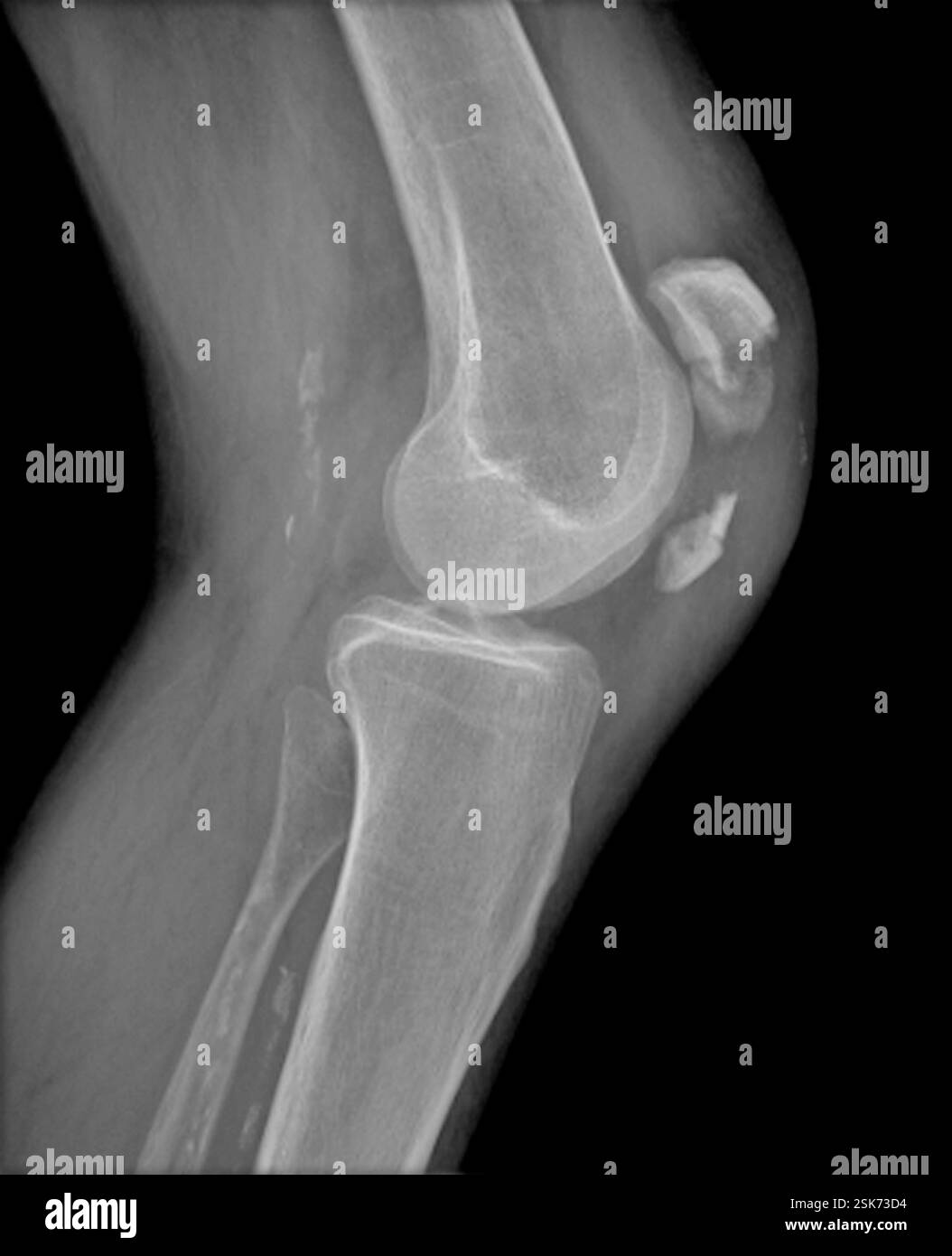 Knee cap fracture. X-ray (side view) of the left knee of a 64-year-old ...