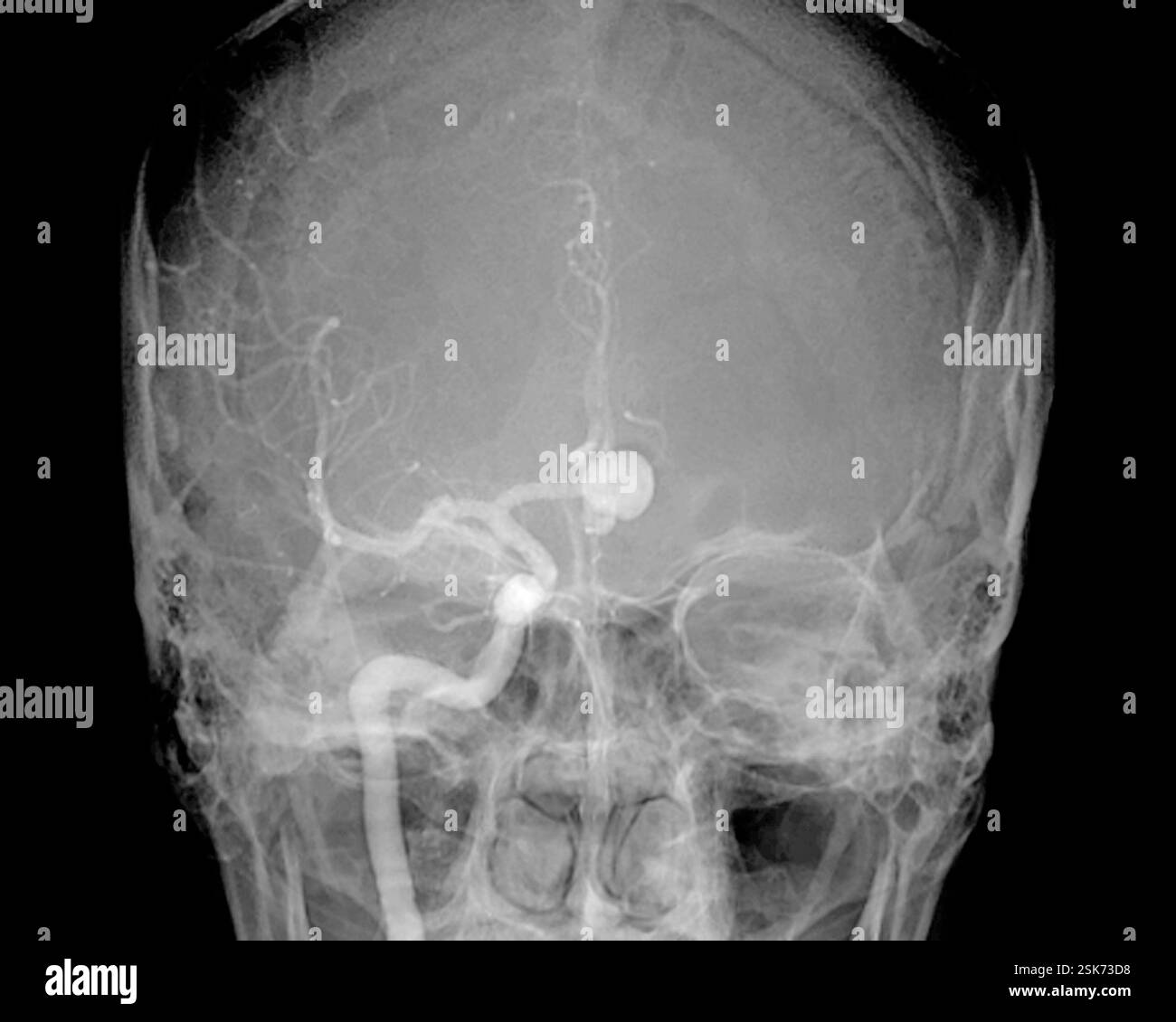 Brain aneurysm. Frontal angiogram of the head of a 42-year-old woman ...