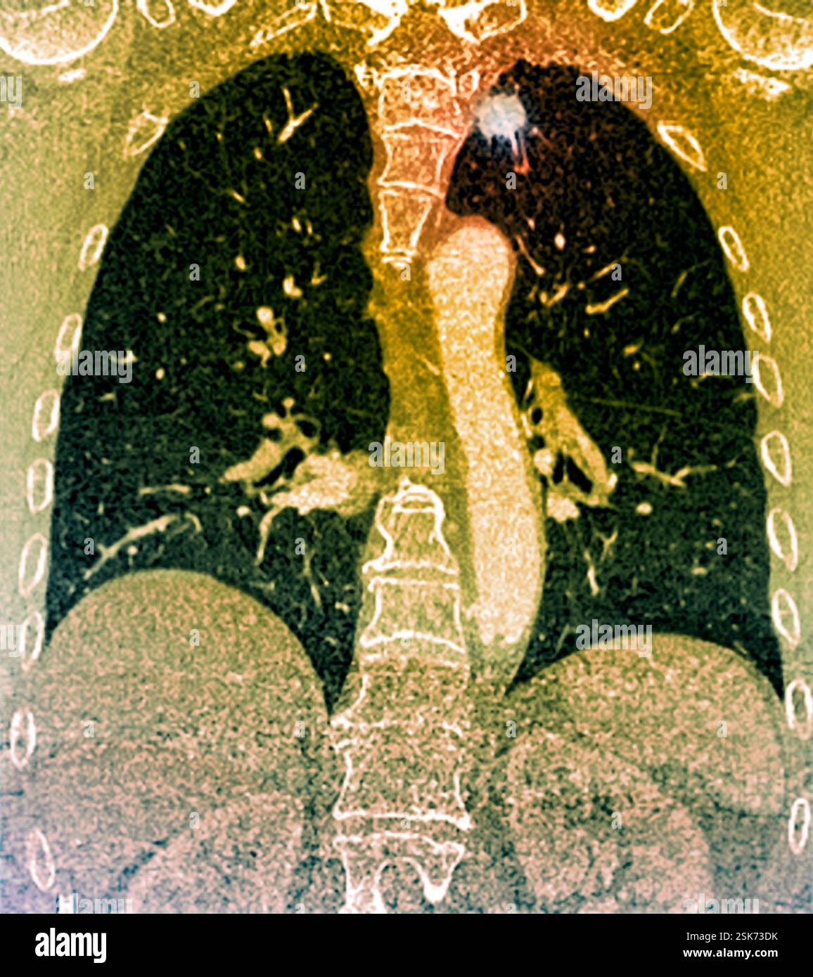 Lung cancer. Coloured computed tomography (CT) scan of a section through the chest of a 67-year ...