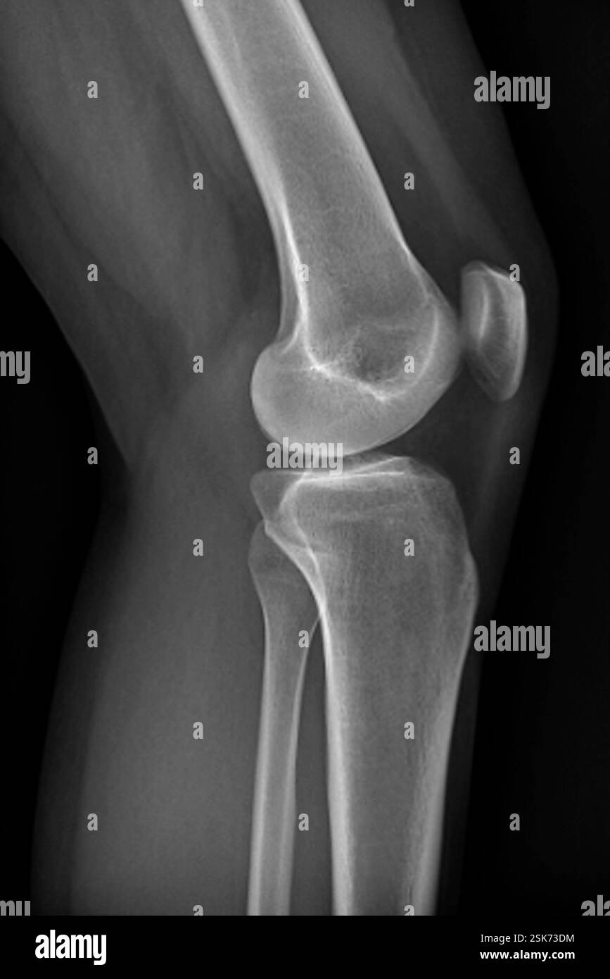 Normal knee. X-ray (side view) of the healthy left knee joint of a 22 ...