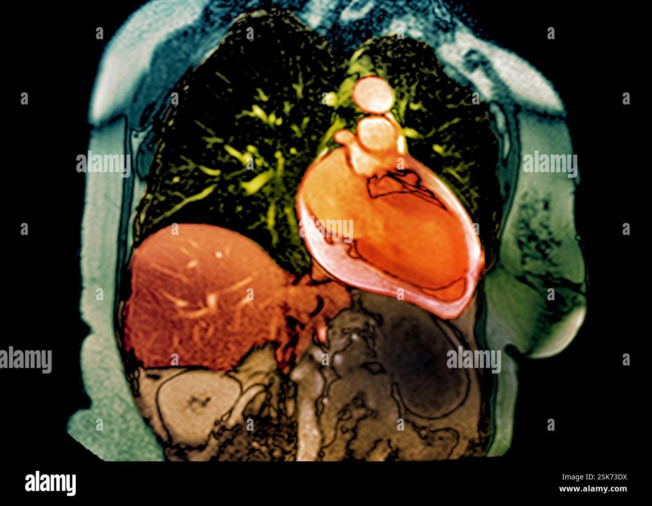 Pericarditis. Coloured magnetic resonance imaging (MRI) scan of a ...
