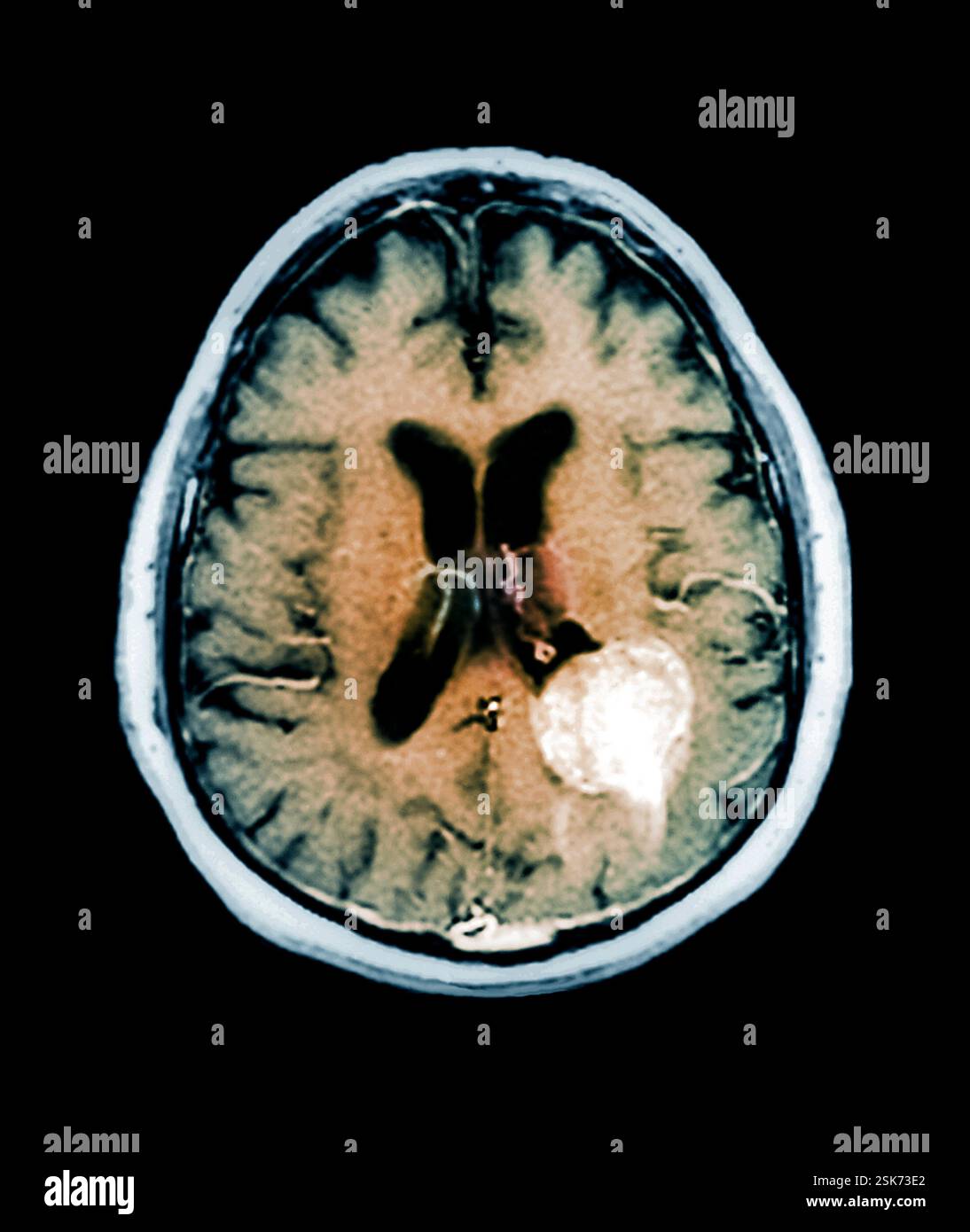 Benign brain tumour. Coloured magnetic resonance imaging (MRI) scan of an axial section through ...