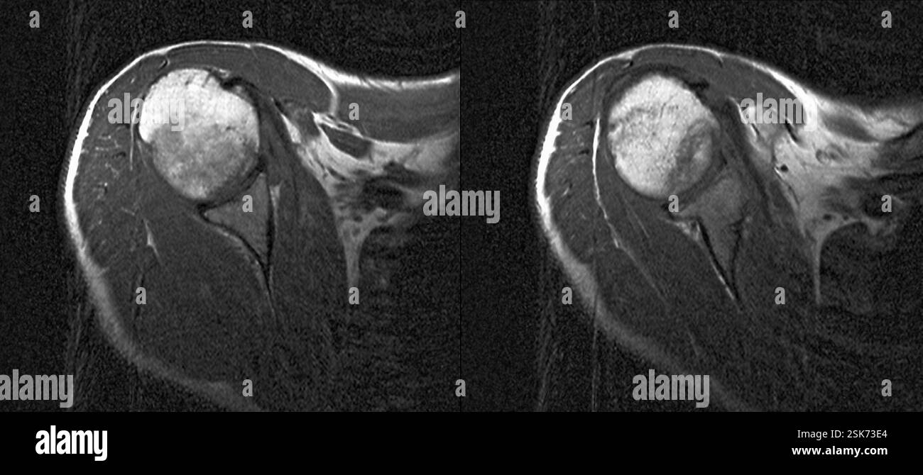 Complex regional pain syndrome. Magnetic resonance imaging (MRI) scans ...