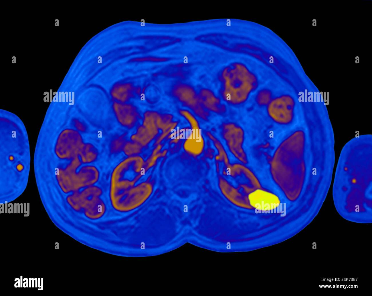 Kidney cancer. Magnetic resonance imaging (MRI) scan of an axial ...