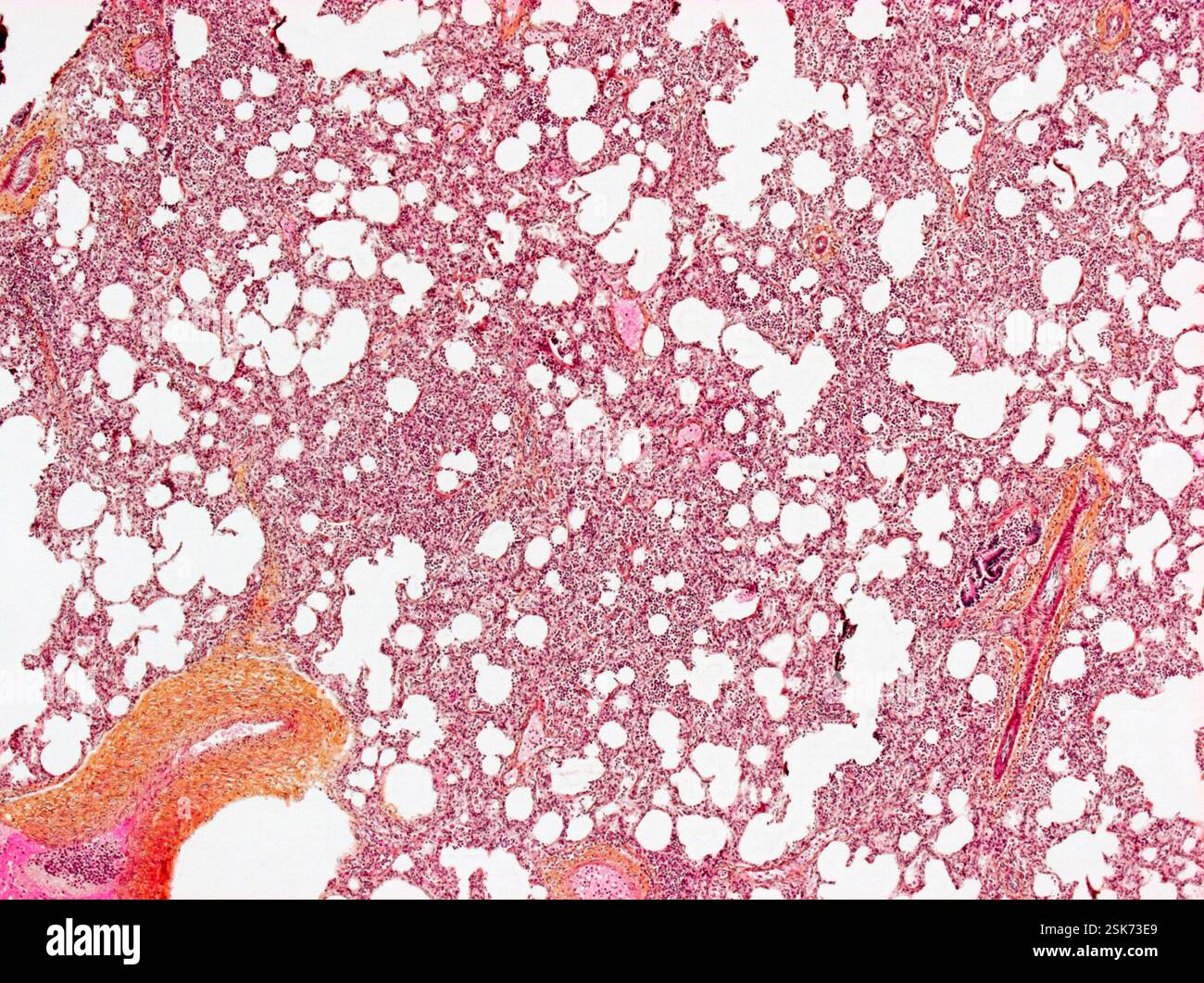 Bronchopneumonia. Light micrograph of a section through lung tissue ...