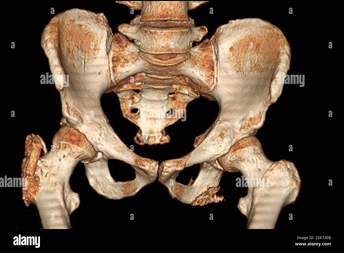 Benign bone tumours. Coloured 3D computed tomography (CT) scan of the ...