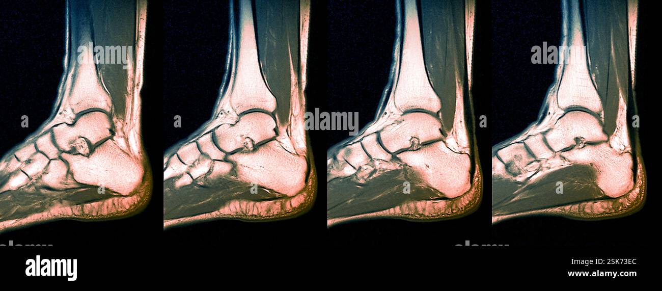Normal ankle. Coloured magnetic resonance imaging (MRI) scans of a ...