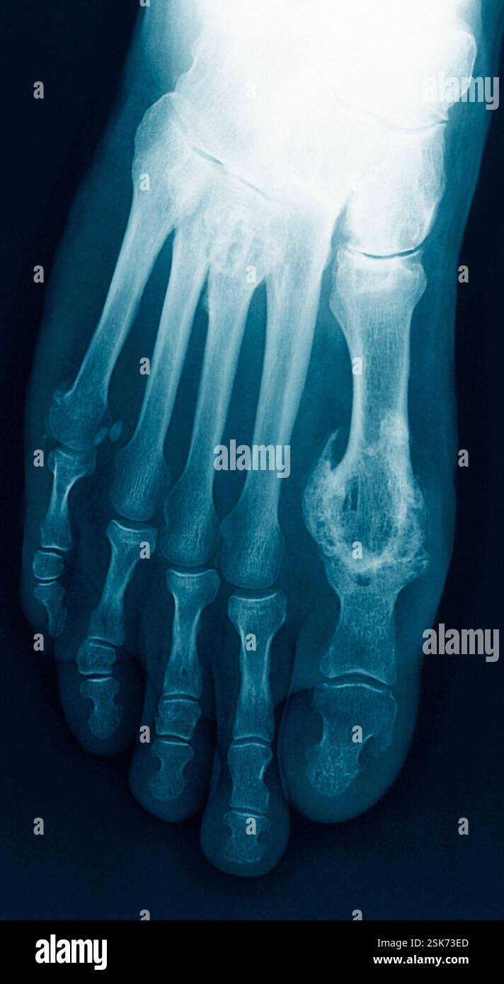 Gout. X-ray of the right foot of a 67-year-old patient, showing damage ...