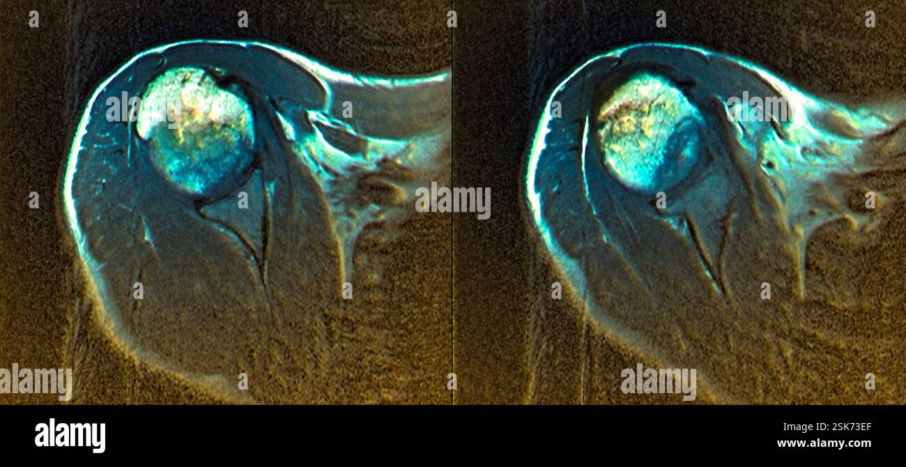 Complex regional pain syndrome. Coloured magnetic resonance imaging ...