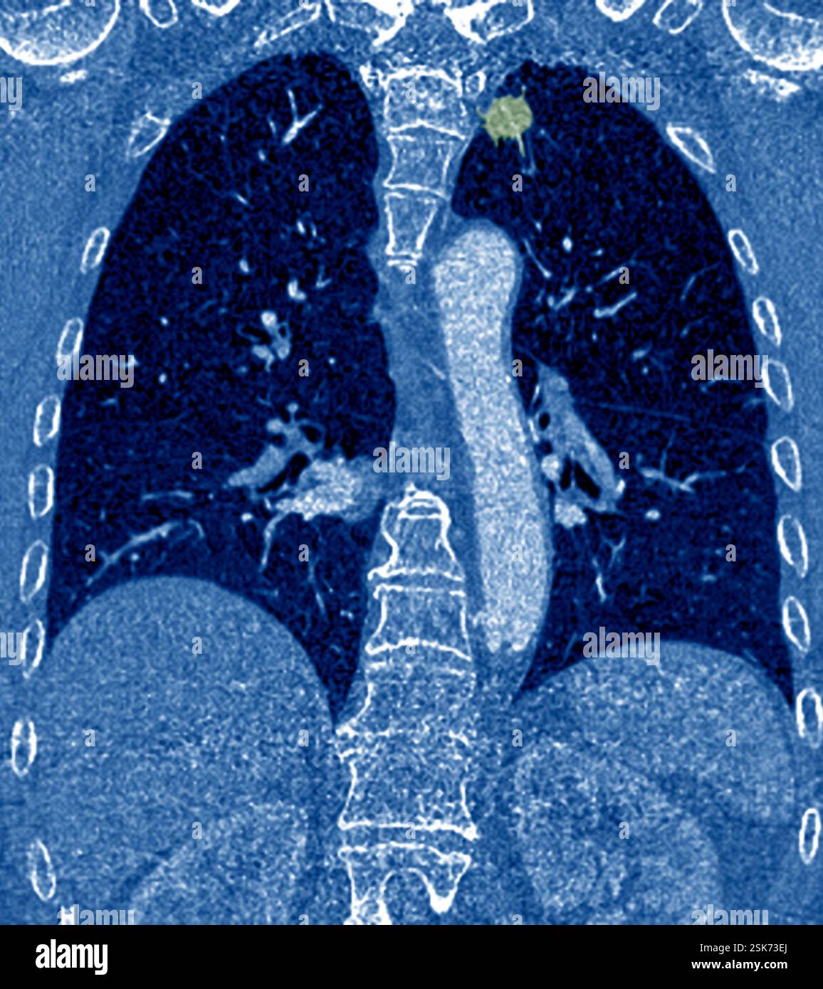 Lung cancer. Coloured computed tomography (CT) scan of a section through the chest of a 67-year ...