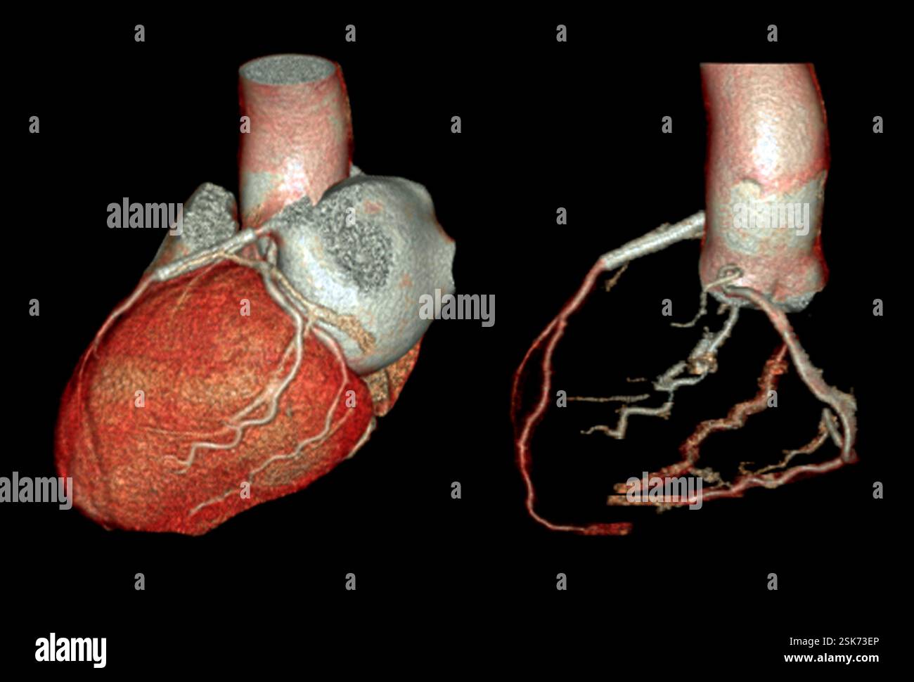 Coronary stents. Coloured 3D computed tomography (CT) scans of the ...