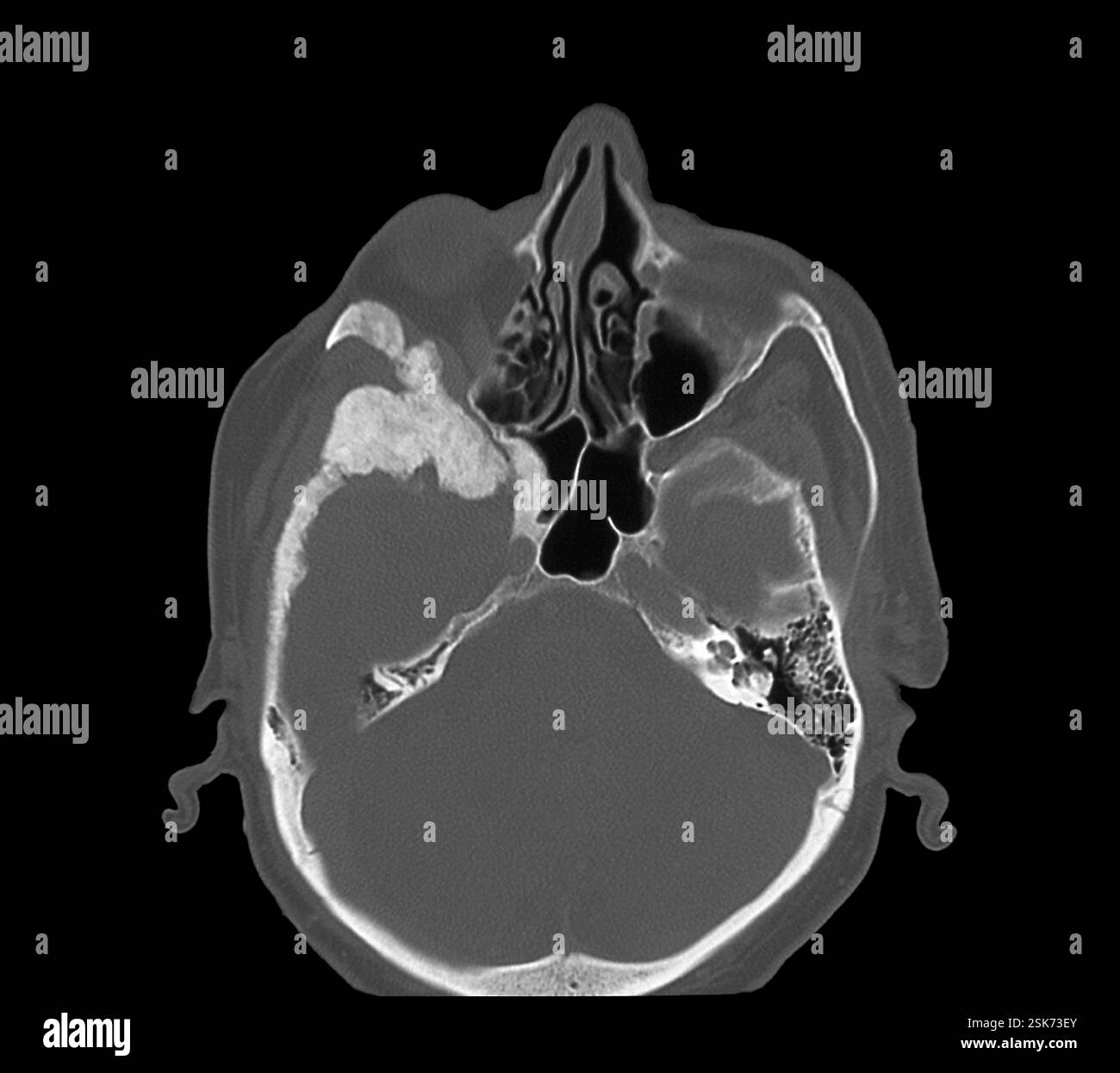 Metastatic bone cancer. Computed tomography (CT) scan of an axial ...