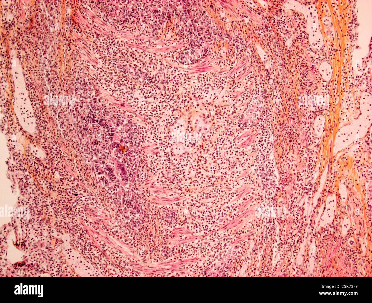 Bronchopneumonia. Light micrograph of a section through lung tissue ...