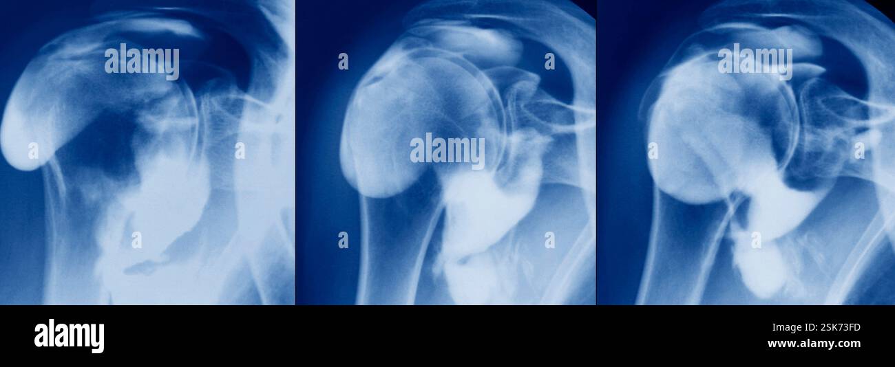Torn shoulder tendons. Series of coloured X-rays of the right shoulder ...