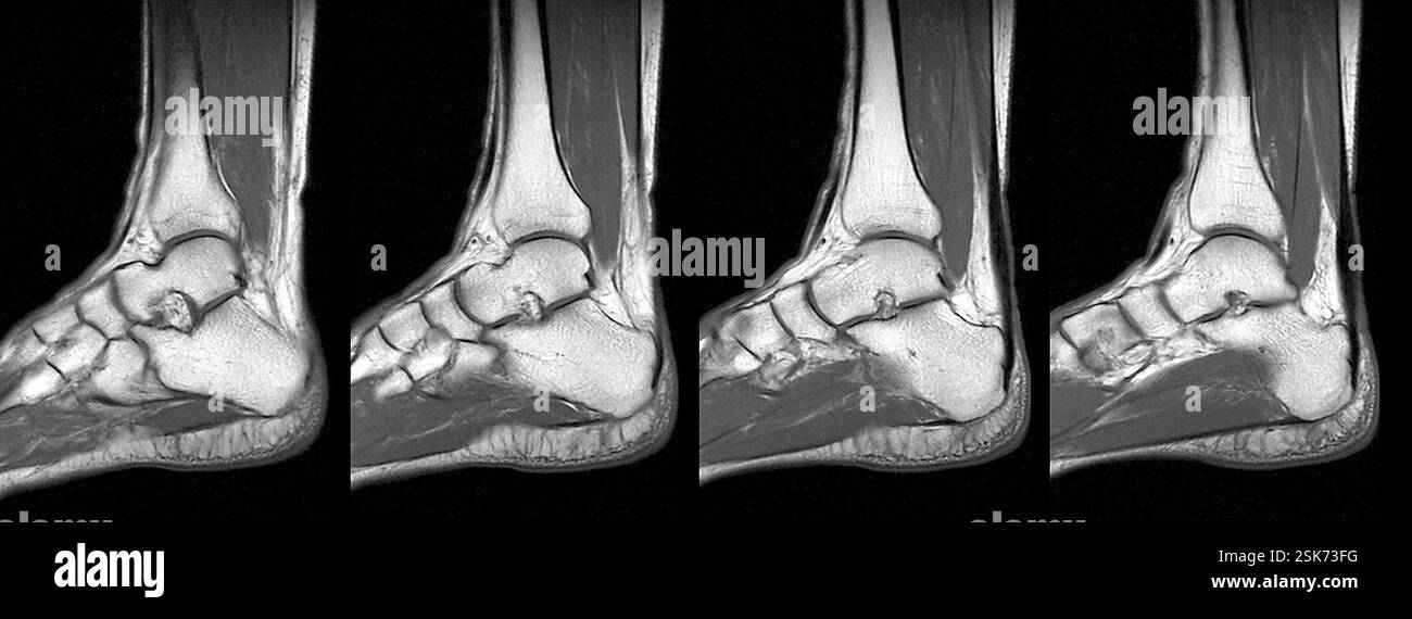 Normal ankle. Magnetic resonance imaging (MRI) scans of a woman's healthy left ankle Stock Photo ...