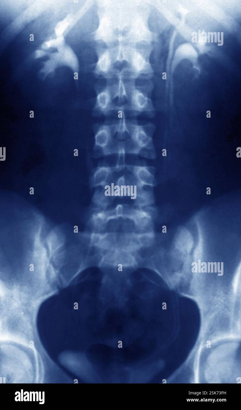 Double ureter anomaly. Coloured urogram (X-ray) of the abdomen of a 40 ...
