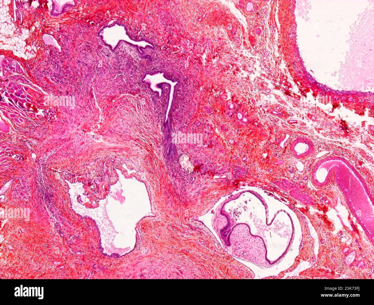 Endometriosis. Light micrograph of a section through a fallopian tube ...