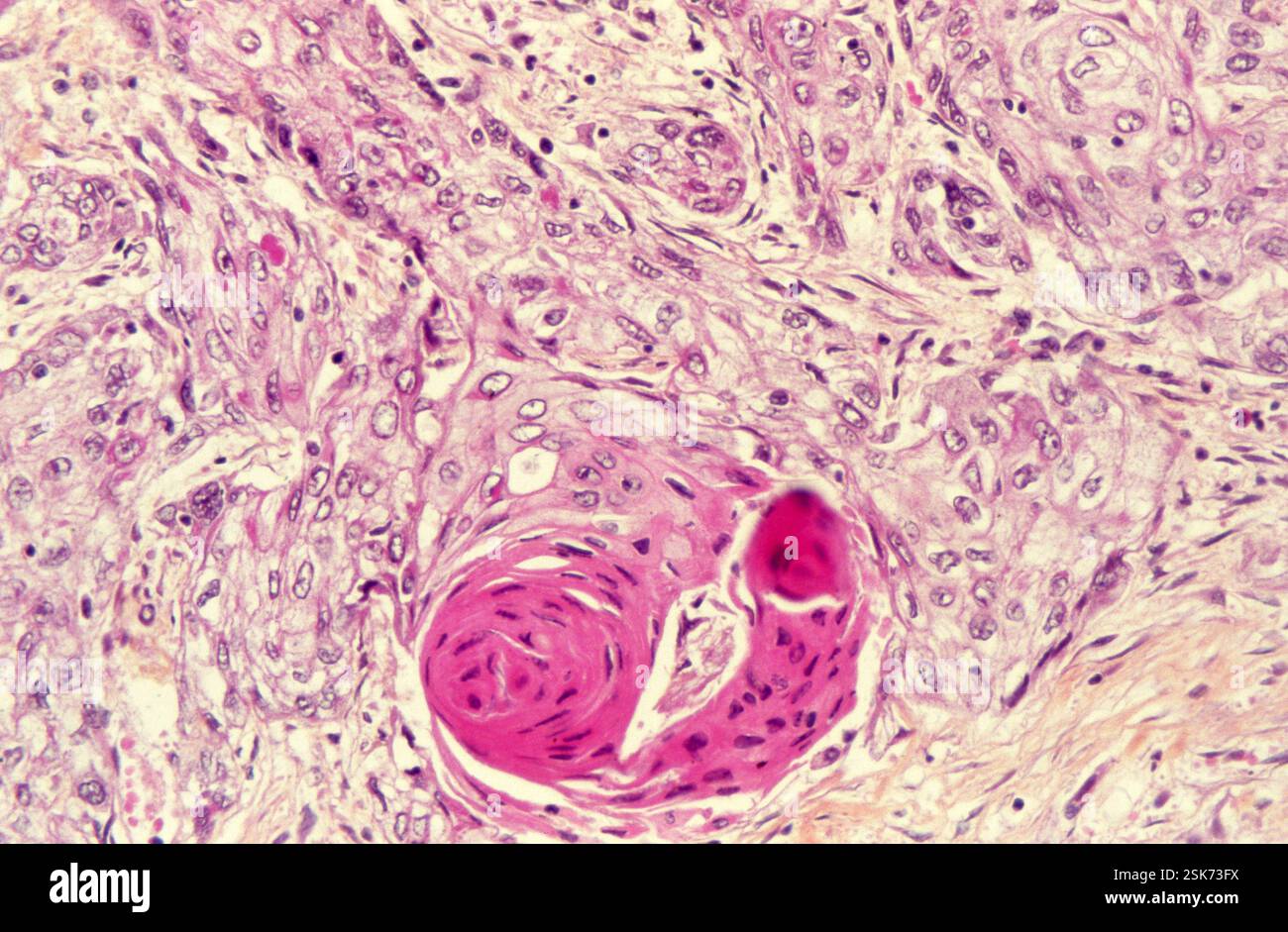 Light micrograph of an invasive squamous cell carcinoma (SCC) of the ...
