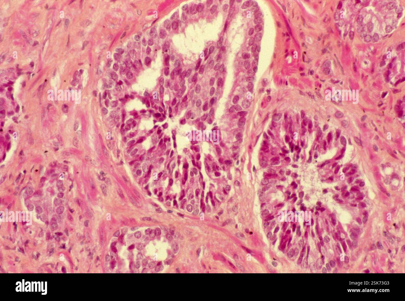 Light micrograph of an adenocarcinoma of the prostate, shown by ...