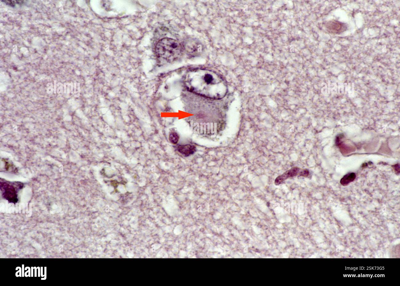 Light micrograph showing a section of the brain of a patient with ...