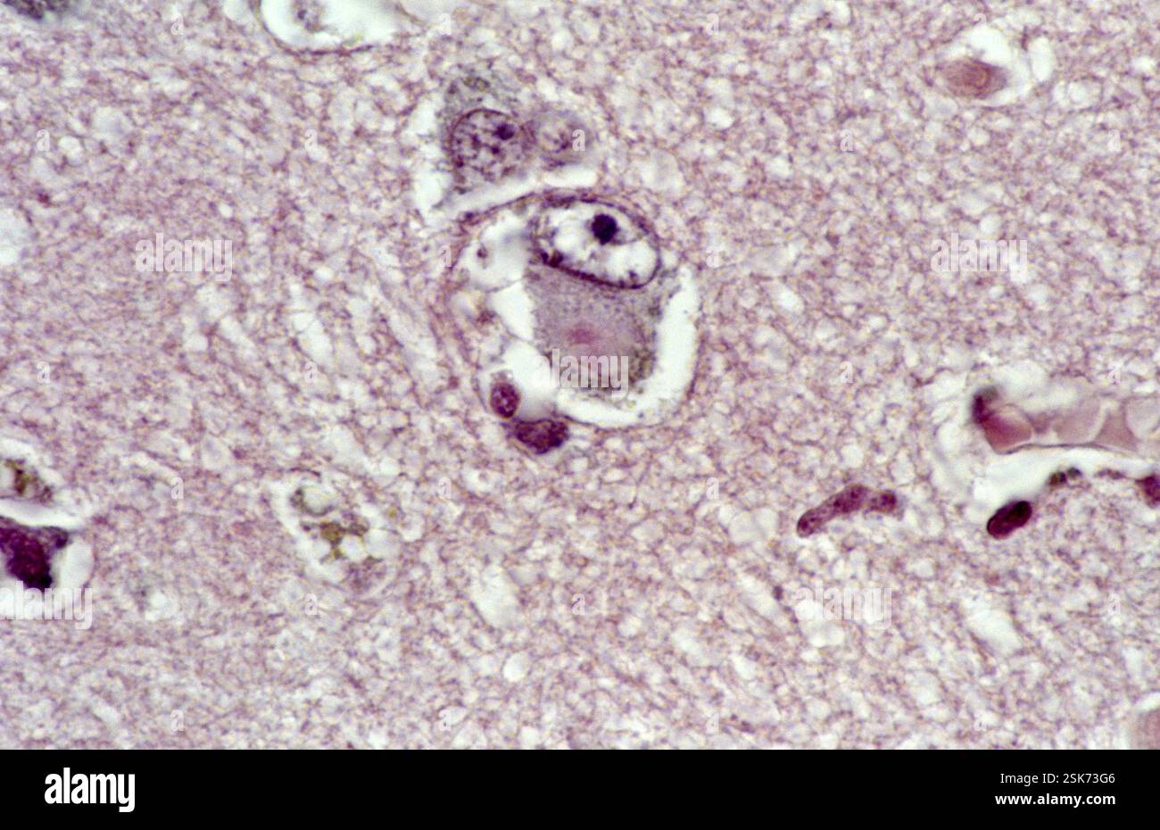 Light micrograph showing a section of the brain of a patient with ...