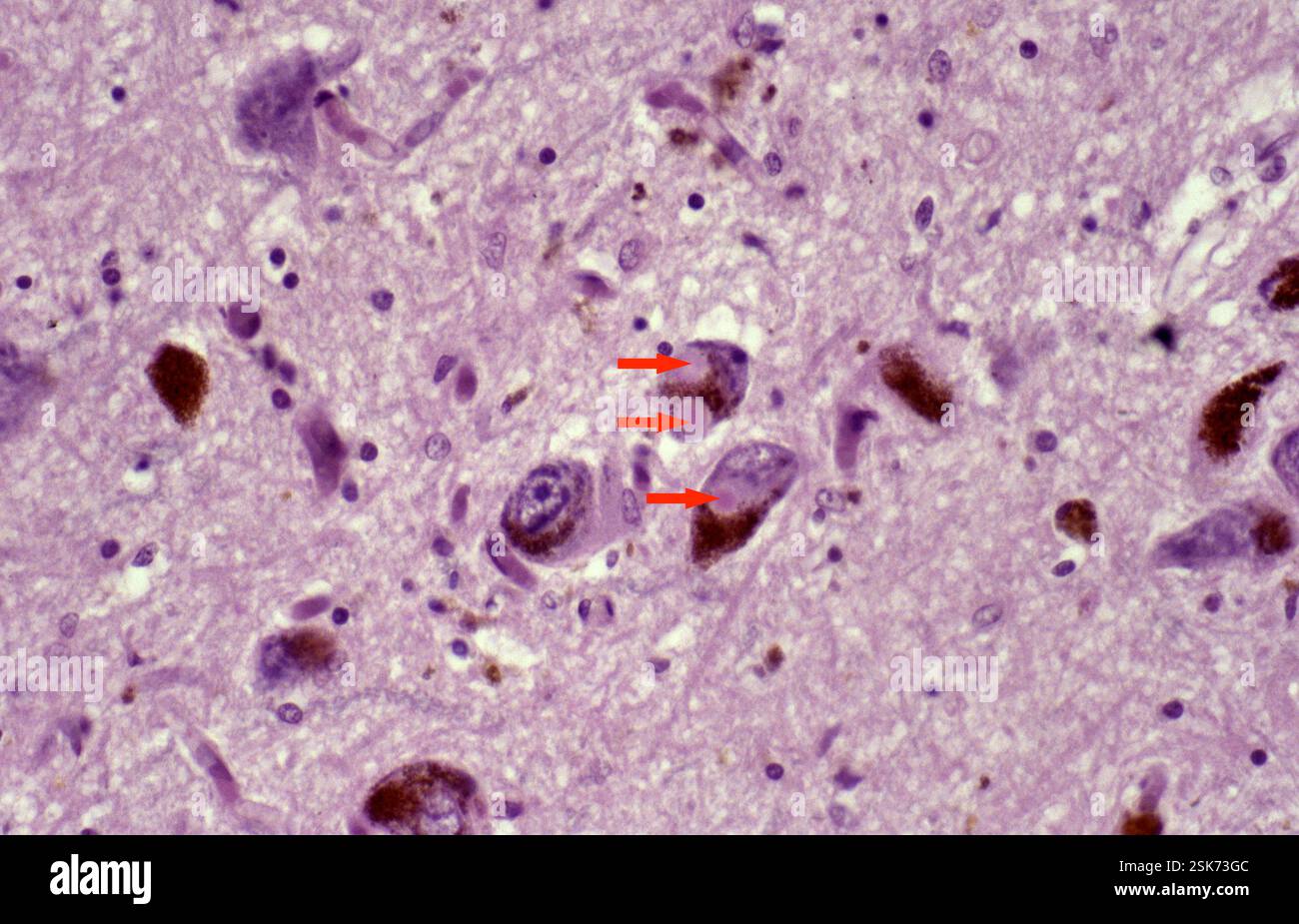 Light micrograph showing a section of the brain of a patient with ...